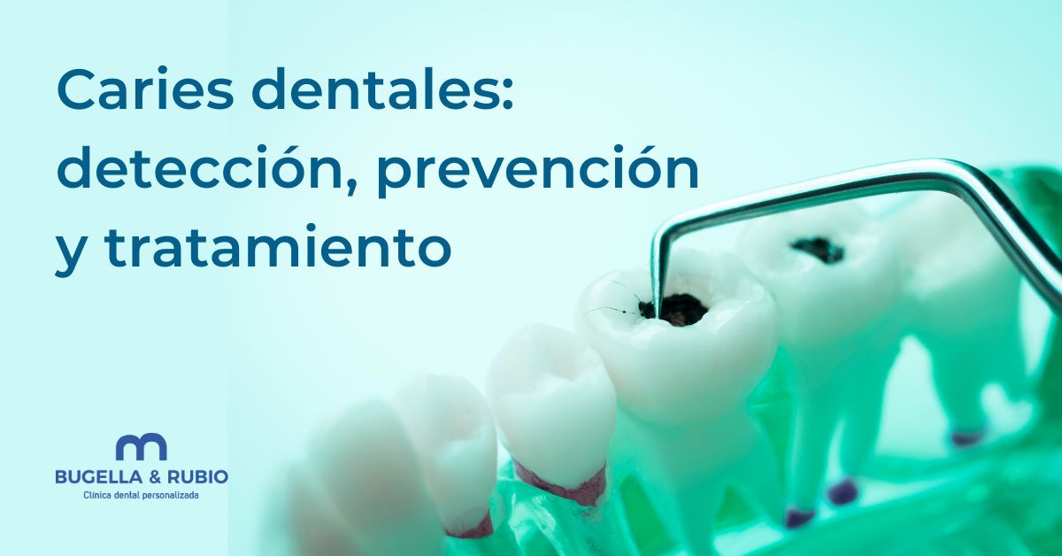Todo sobre las caries dentales | Clínica dental Bugella & Rubio
